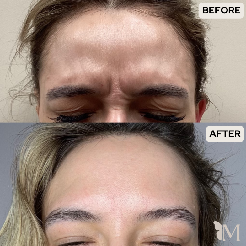 Neurotoxin (Botox + Dysport) | Injectables | Morphia Beauty Clinic